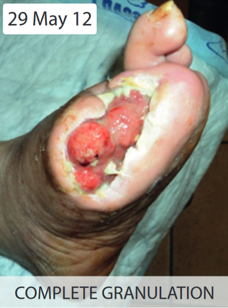 Hyperoil™ Oil Formulation in Healing Diabetic Foot Ulcers: Step-by-Step ...