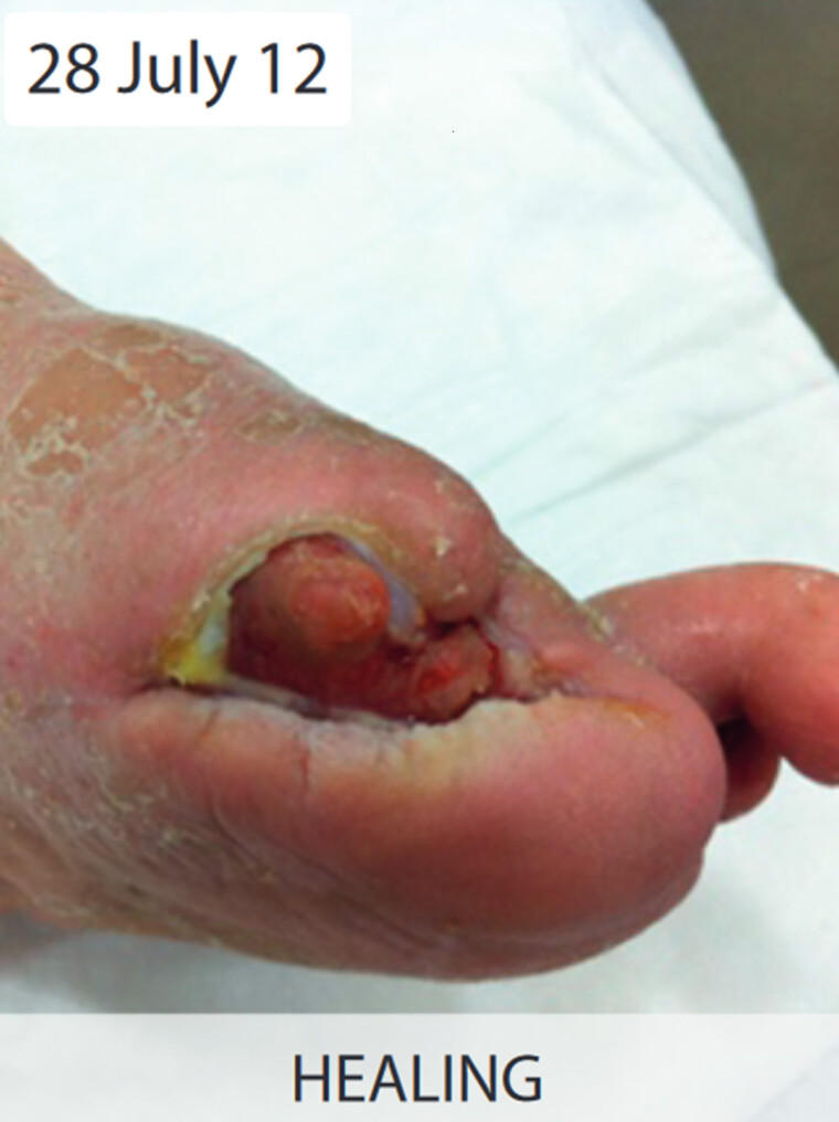 Hyperoil™ Oil Formulation in Healing Diabetic Foot Ulcers: Step-by-Step ...