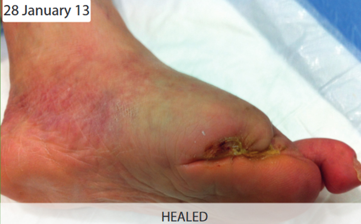 Hyperoil™ Oil Formulation in Healing Diabetic Foot Ulcers: Step-by-Step ...